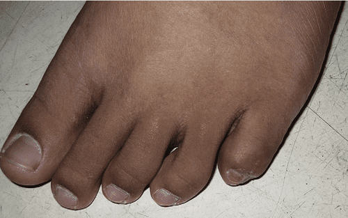 Table 1 from Giant cell tumor of the distal phalanx of the biphalangeal ...