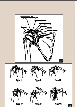 Figure 1 from Modified Weaver-Dunn procedure for acromioclavicular ...