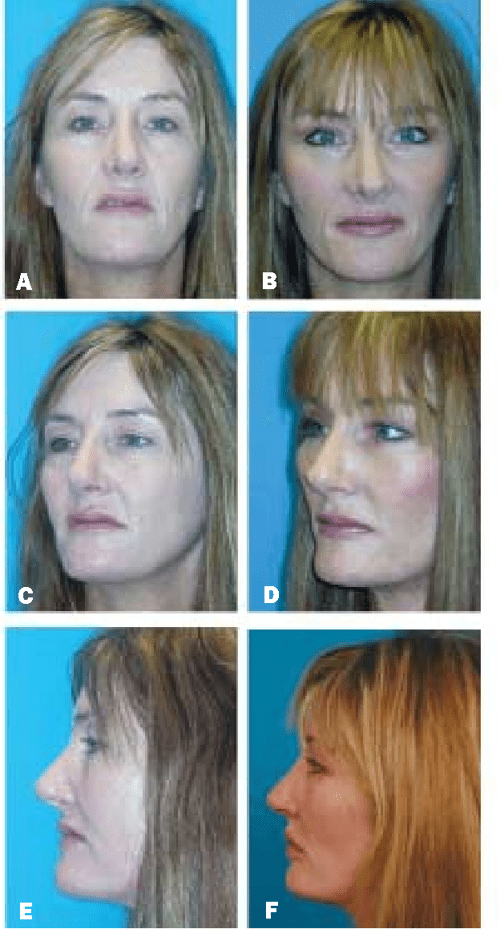 Figure 4 from Endoscopic temporal-incision only midface lift is ...