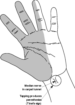 Tinel's Sign and Phalen's Maneuver: Physical Signs of Carpal Tunnel ...