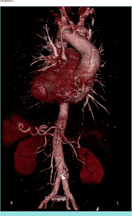 Figure 4 from Ascending Aorta and Aortic Root Replacement With the ...