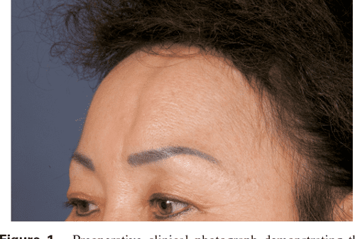 Figure 1 from Treatment of linear scleroderma “en coup de sabre” with ...