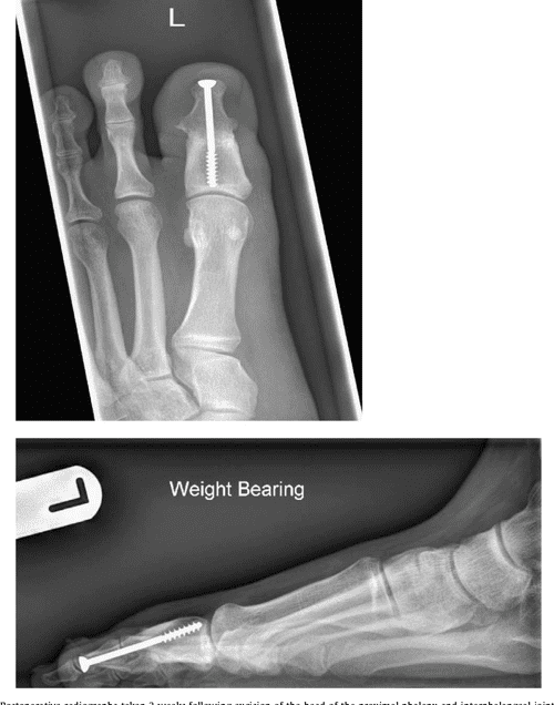 Figure 5 from Osteoid osteoma of the great toe: A case report ...
