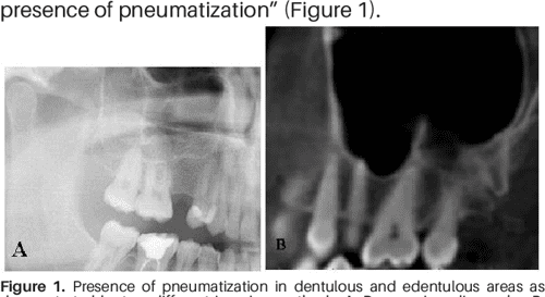 Figure 1 from Evaluation of alveolar pneumatization in maxillary sinus ...