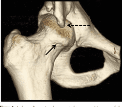 Figure 1 from Pincer-Type Femoroacetabular Impingement | Semantic Scholar