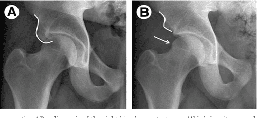 Figure 1 from Pincer-Type Femoroacetabular Impingement | Semantic Scholar