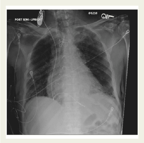 Figure 1 from Utility and safety of temporary pacing using active ...