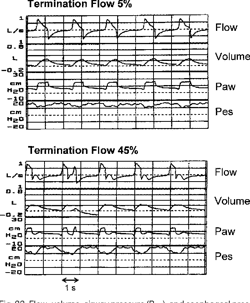 [PDF] Ventilator waveforms and the physiology of pressure support ...