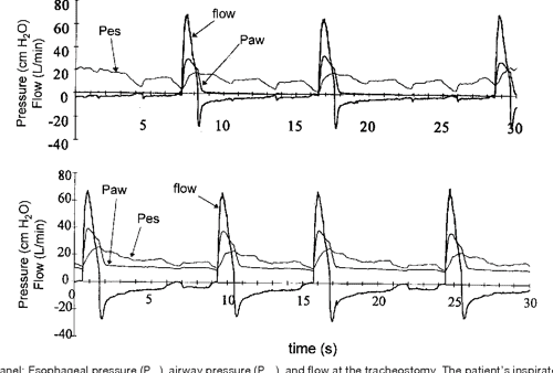 [PDF] Ventilator waveforms and the physiology of pressure support ...