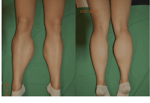 Figure 1 from Bilateral idiopathic calf muscle hypertrophy: an ...