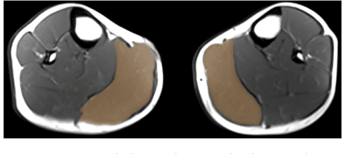 Figure 1 from Bilateral idiopathic calf muscle hypertrophy: an ...