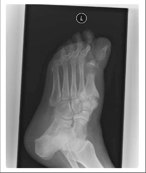 Figure 1 from Primary Closure With a Filleted Hallux Flap After ...