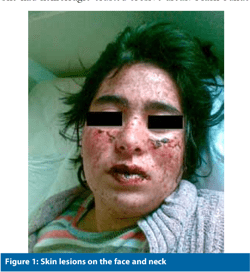 Figure 2 from Stevens Johnson Syndrome - Toxic Epidermal Necrolysis ...