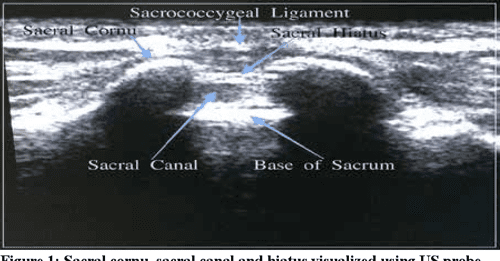 Figure 3 from Comparison of pediatric caudal block with ultrasound ...