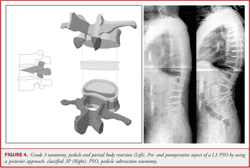 [PDF] The Comprehensive Anatomical Spinal Osteotomy Classification ...