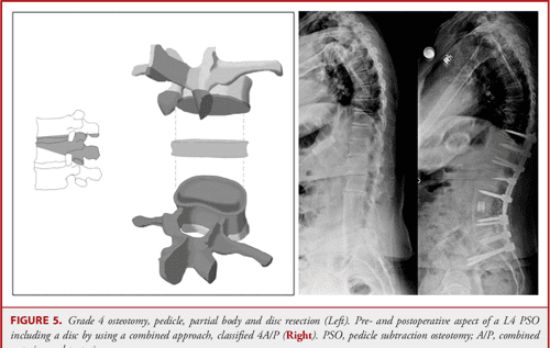 [PDF] The Comprehensive Anatomical Spinal Osteotomy Classification ...