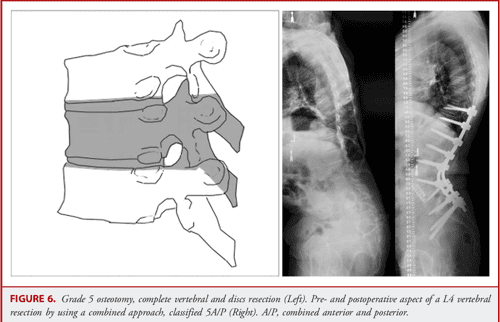 [PDF] The Comprehensive Anatomical Spinal Osteotomy Classification ...