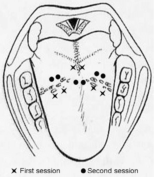 Figure 2 from Tongue base suspension and radiofrequency volume ...