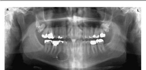 Figure 1 from Anterior Stafne's bone cavity mimicking a periapical ...