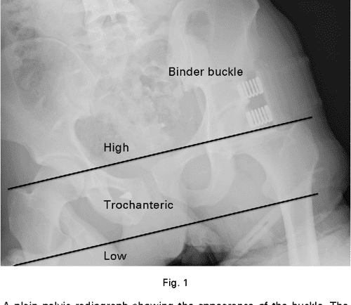 Figure 3 from Accurate placement of a pelvic binder improves reduction ...