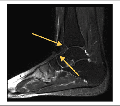 Imaging of the Tibionavicular Ligament, and Its Potential Role in Adult ...