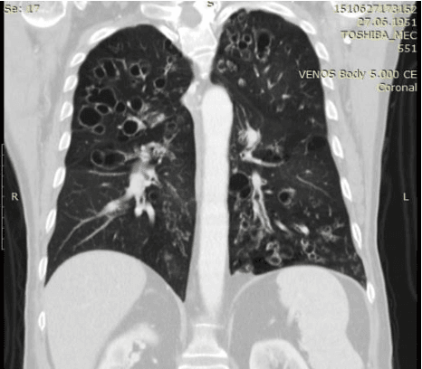Figure 1 from POLYCYSTIC LUNG DISEASE: CASE REPORT | Semantic Scholar
