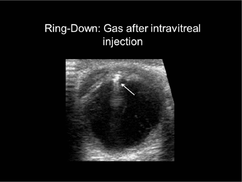 Ring-Down versus Comet Tail: Two artifacts uncovered | Semantic Scholar