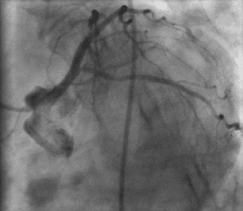 Figure 2 from Indications for Coronary Angiography | Semantic Scholar