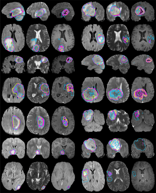 [pdf] The Multimodal Brain Tumor Image Segmentation Benchmark Brats