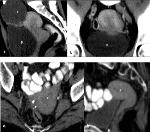 Figure 4 from iliac artery Uterine artery Vaginal arteries Round ...