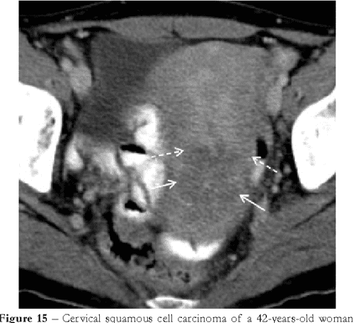 Figure 13 from iliac artery Uterine artery Vaginal arteries Round ...