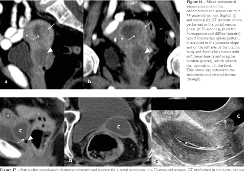 Figure 13 from iliac artery Uterine artery Vaginal arteries Round ...