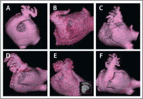 Table 2 from Left atrial appendage closure with the watchman device: A ...