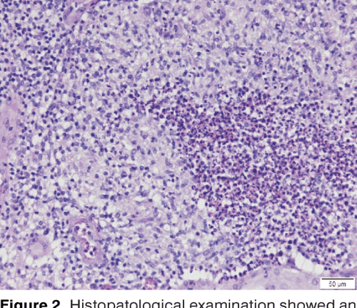 Figure 3 from Fish Tank Granuloma – a Case Report | Semantic Scholar