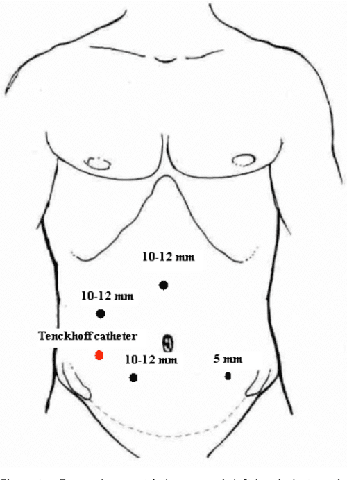Laparoscopic Left Hemicolectomy for Colon Cancer in Peritoneal Dialysis ...