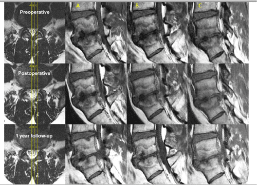 Figure 6 from Lumbar Degenerative Disease Part 1: Anatomy and ...