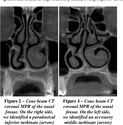 Variant anatomy of nasal turbinates: supreme, superior and middle ...
