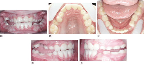 Figure 1 from Infraocclusion of Secondary Deciduous Molars – an Unusual ...