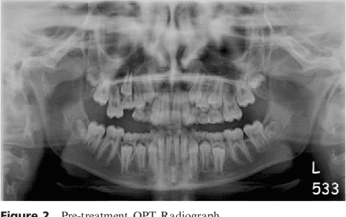 Figure 1 from Infraocclusion of Secondary Deciduous Molars – an Unusual ...