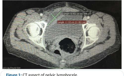 [PDF] Pelvic Lymphocele Enlargement after Manual Lymph Drainage: Case ...
