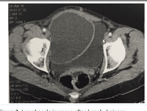 Figure 3 from Pelvic Lymphocele Enlargement after Manual Lymph Drainage ...