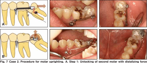 [PDF] Uprighting mandibular second molars with direct miniscrew ...