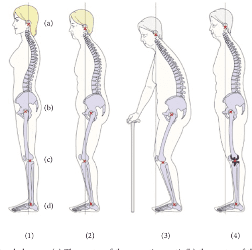 Figure 1 from Knee–Hip–Spine Syndrome: Improvement in Preoperative ...