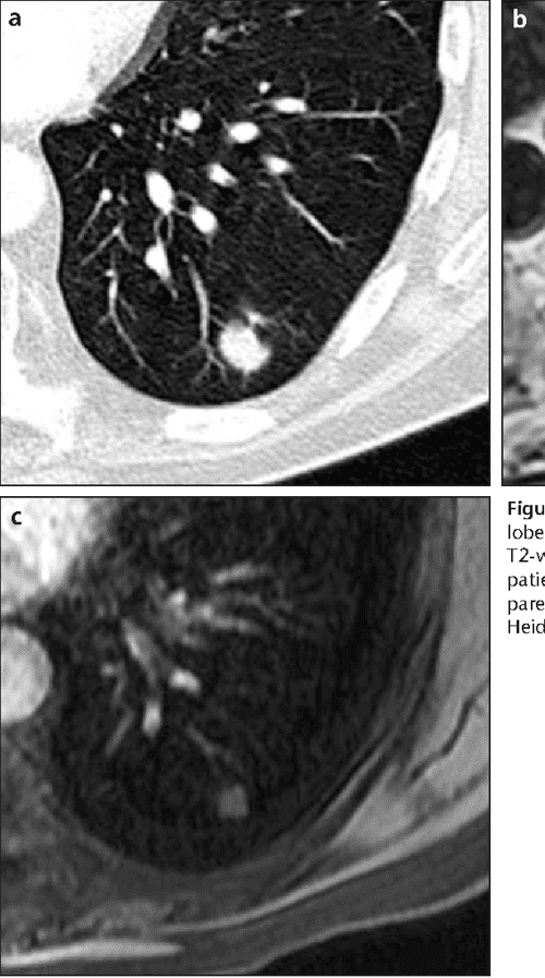 Figure 2 from MRI of the lung: state of the art. | Semantic Scholar