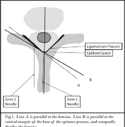 Optimal Angle of Contralateral Oblique View in Cervical Interlaminar ...