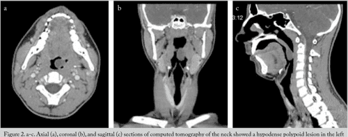 Figure 3 from Unilateral Pedunculated Lymphangiectatic Fibrolipomatous ...