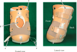 Stabilizing transpelvic prosthetic socket for a patient with spinal ...