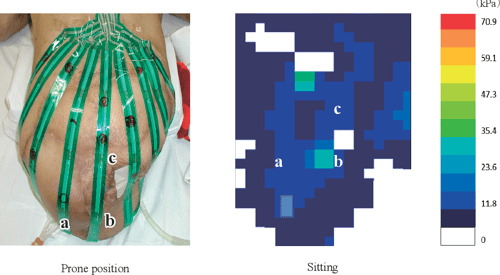 Stabilizing transpelvic prosthetic socket for a patient with spinal ...