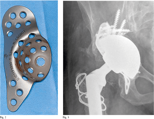 The Evolution of the Cup-Cage Technique for Major Acetabular Defects ...