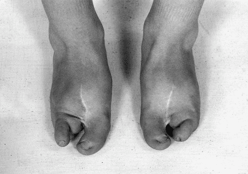 Figure 4 from Congenital cleft foot deformity. | Semantic Scholar